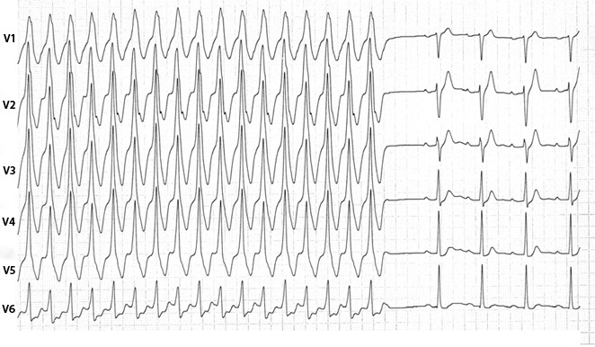 Klasse-I-Antiarrhythmika | SpringerLink