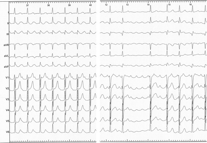 Oberflächen-EKG-Charakteristika von rechts- und linksatrialem ...