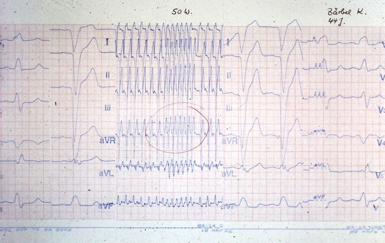 Das EKG beim Sportler | SpringerLink