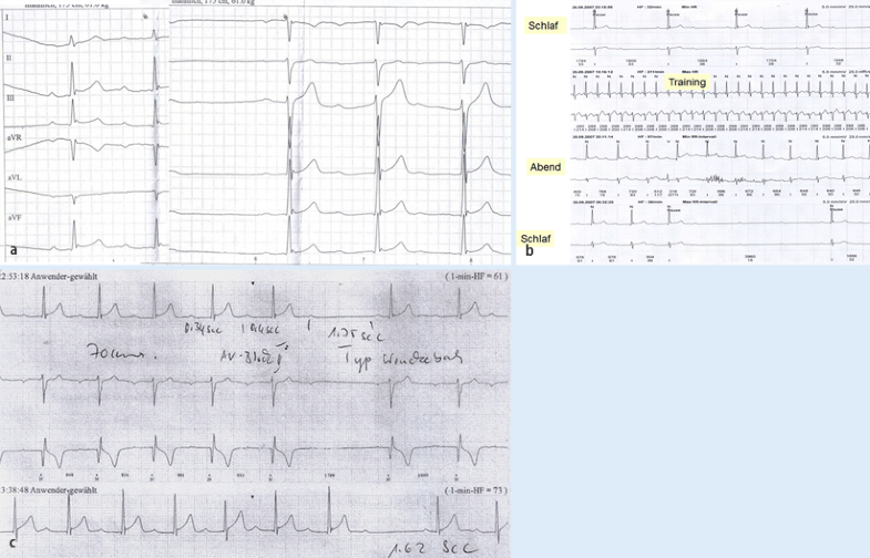 Das EKG beim Sportler | SpringerLink