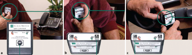 Implantierbare Loop-Rekorder der Confirm-Familie (Fa. St. Jude Medical ...