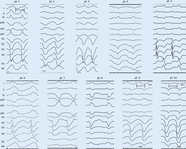 Bundle-Branch-Reentry-VT | SpringerLink