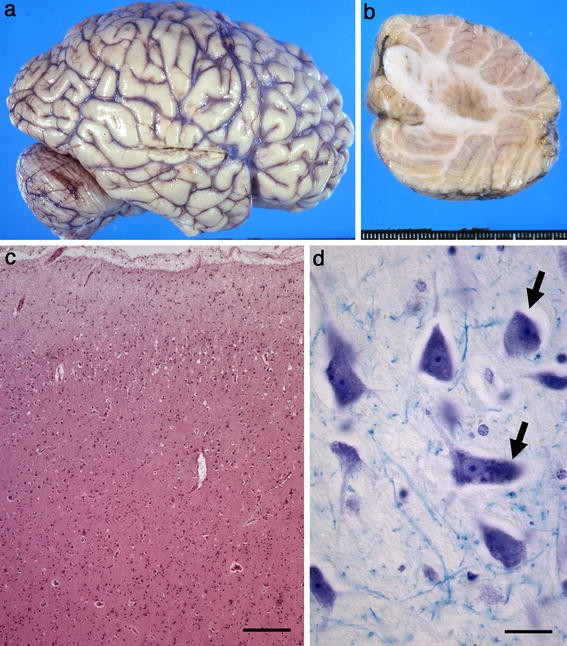 Sialidosis type I carrying V217M/G243R mutations in lysosomal sialidase ...