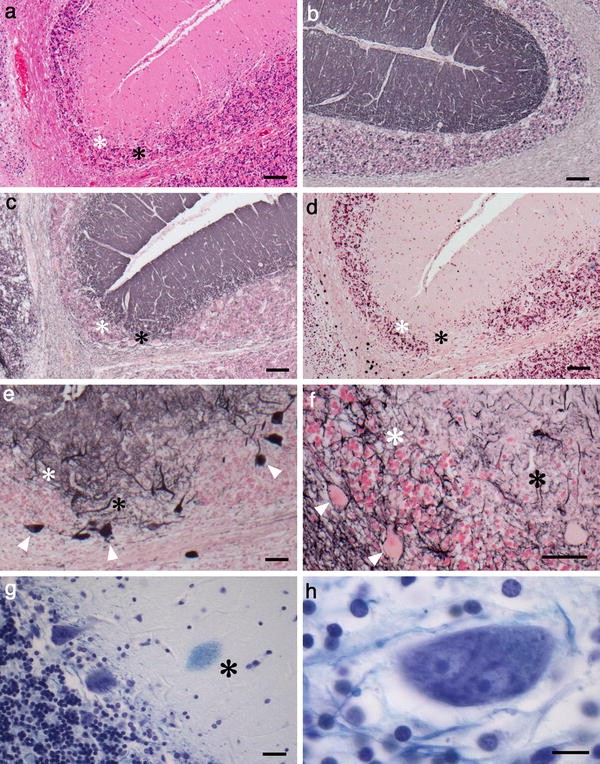 Sialidosis type I carrying V217M/G243R mutations in lysosomal sialidase ...