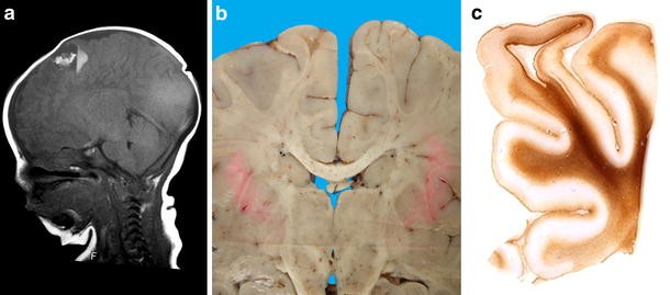 The “Shaken Baby” syndrome: pathology and mechanisms | SpringerLink