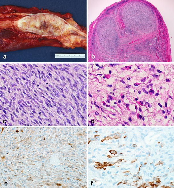 Pathology of peripheral nerve sheath tumors: diagnostic overview and ...
