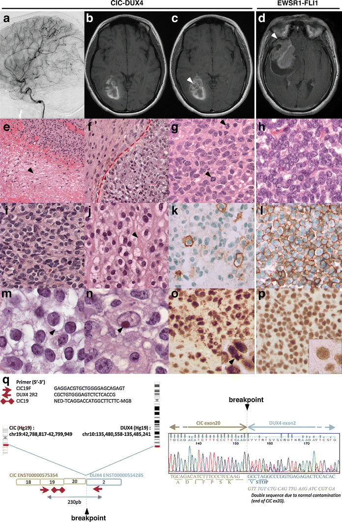 Unusual primary cerebral localization of a CIC–DUX4 translocation tumor ...