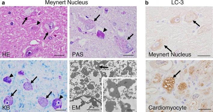 Danon disease: a phenotypic expression of LAMP-2 deficiency | SpringerLink