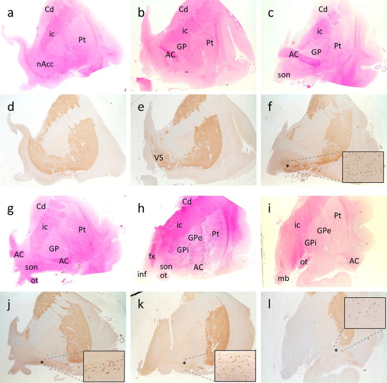 Nucleus basalis of Meynert revisited: anatomy, history and differential ...