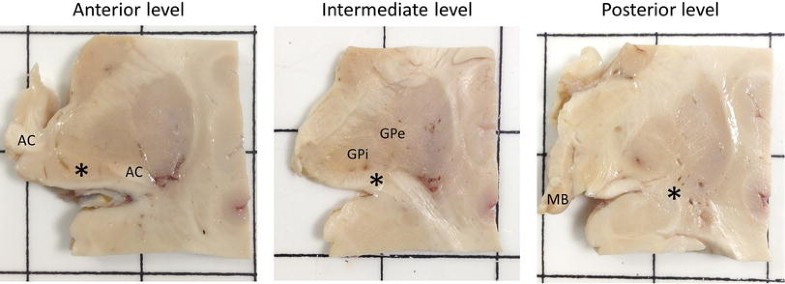 Nucleus basalis of Meynert revisited: anatomy, history and differential ...