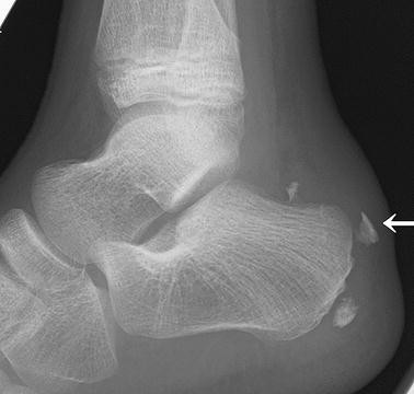 Calcaneal apophyseal avulsion fracture | SpringerLink
