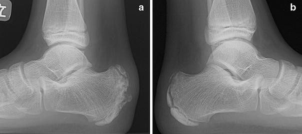 Calcaneal apophyseal avulsion fracture | SpringerLink