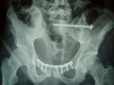 Internal fixation of traumatic diastasis of pubic symphysis: is plate ...