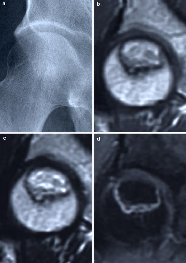 Contrast-enhanced MR imaging of subchondral insufficiency fracture of ...
