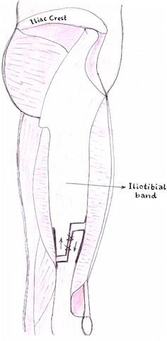 Distal lengthening of ilio-tibial band by Z-plasty for treating ...