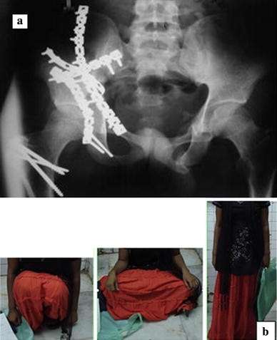 Digastric trochanteric flip osteotomy and surgical dislocation of hip ...