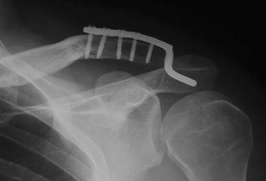 Hook plate fixation for acromioclavicular joint separations restores ...