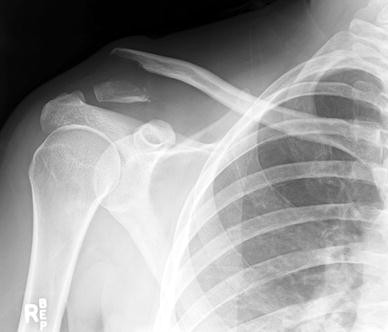 Treatment of Neer type II fractures of the lateral clavicle using ...