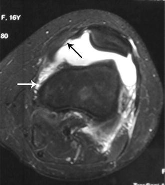 Medial patellar retinaculum plasty versus medial capsule reefing for ...