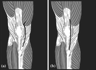 Mini-midvastus versus mini-medial parapatellar approach in total knee ...