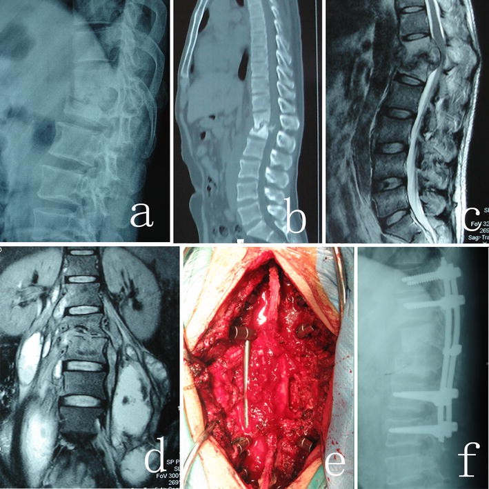 Thoracolumbar spinal tuberculosis with psoas abscesses treated by one ...