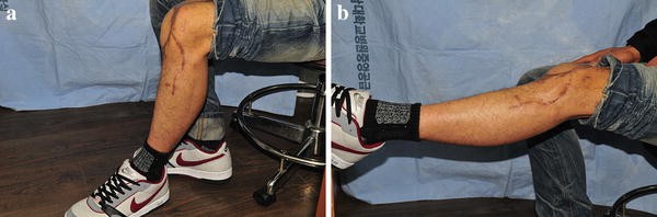 The composite anterolateral thigh flap for knee extensor and skin ...