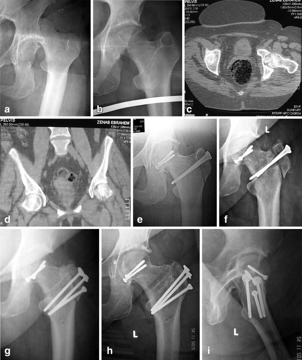 Operative treatment of displaced Pipkin type I and II femoral head ...