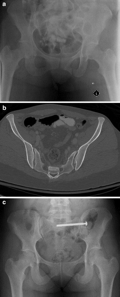 Displaced inferior ramus fractures as a marker of posterior pelvic ...