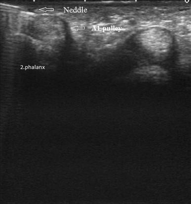 Corticosteroid injection for trigger finger: blinded or ultrasound ...