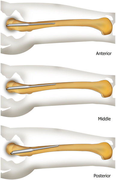 Cephalomedullary nails: factors associated with impingement of the ...