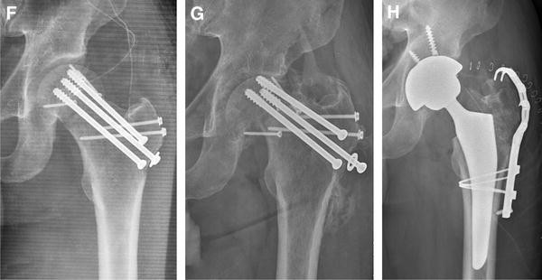A treatment strategy to avoid iatrogenic Pipkin type III femoral head ...
