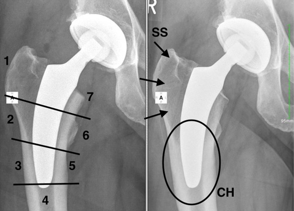 Outcome of extensive varus and valgus stem alignment in short-stem THA ...