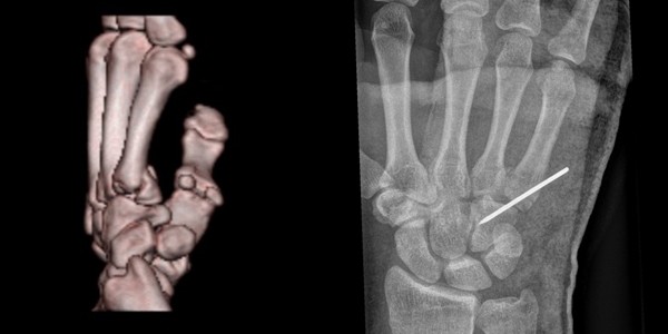 Total wrist arthrodesis for septic wrist arthritis and loss of the bony ...