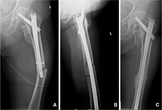 Secondary femur shaft fracture following treatment with ...