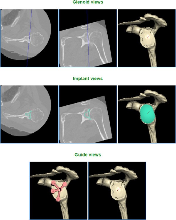 Replacement options for the B2 glenoid in osteoarthritis of the ...
