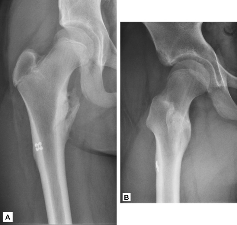 Retrograde fixation of the lesser trochanter in the adolescent: new ...
