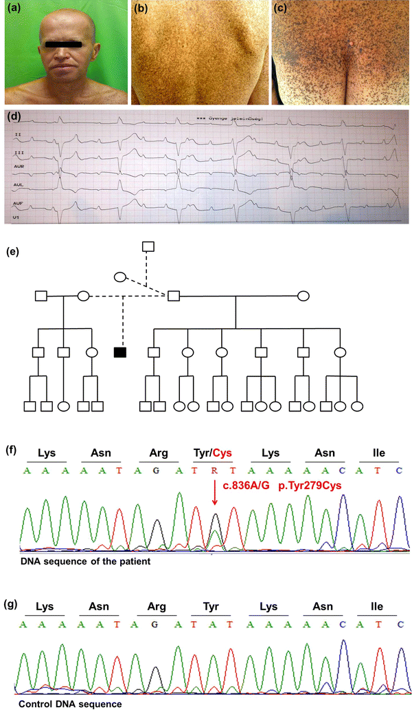 Phenotypical diversity of patients with LEOPARD syndrome carrying the ...