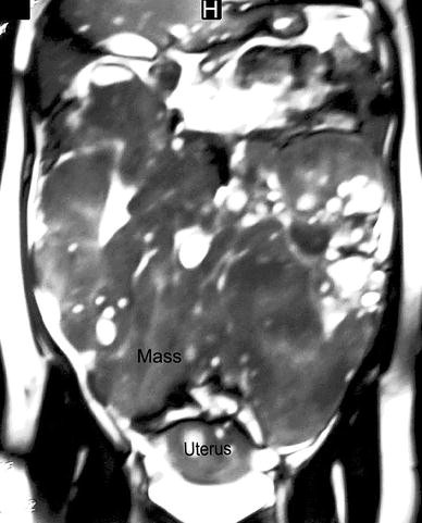 Disseminated peritoneal leiomyomatosis: an unusual complication of ...