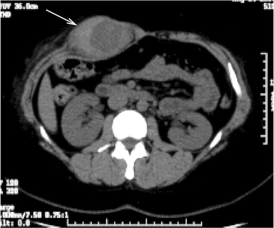 Desmoid tumors of the right rectus abdominus muscle in postpartum women ...