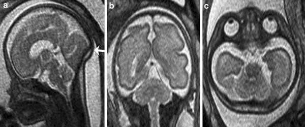 Craniosynostosis: prenatal diagnosis by means of ultrasound and SSSE ...