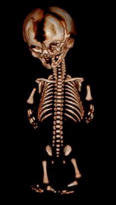 Antenatal three-dimensional sonographic features of Roberts syndrome ...