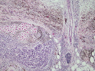 Cellular blue nevus of the vulva mimicking Bartholin’s gland abscess in ...