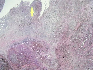 Cellular blue nevus of the vulva mimicking Bartholin’s gland abscess in ...