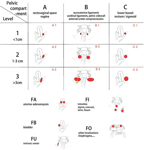 Efficacy of the revised Enzian classification: a retrospective analysis ...