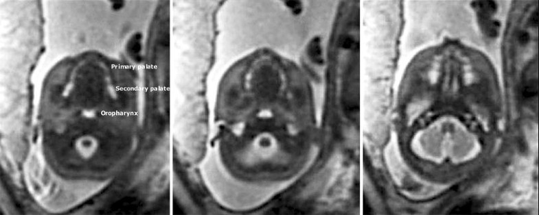 Fetal uvula: navigating and lightening the soft palate using HDlive ...