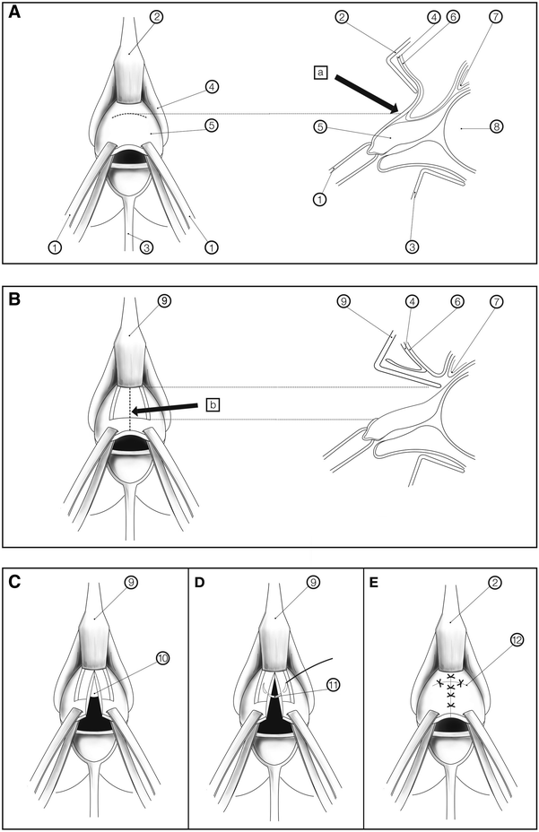 Vaginal cesarean section: heir to, but not legacy of Dührssen’s ...