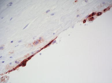 Cervical thoracic duct cyst: a differential diagnosis of left ...