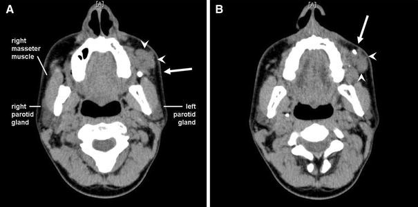 Accessory parotid gland lesions: case report and review of literature ...