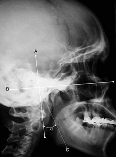 Angulation of the styloid process in Eagle’s syndrome | SpringerLink