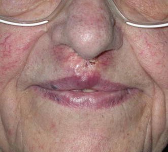 One-stage reconstruction of the entire upper lip and the columella with ...